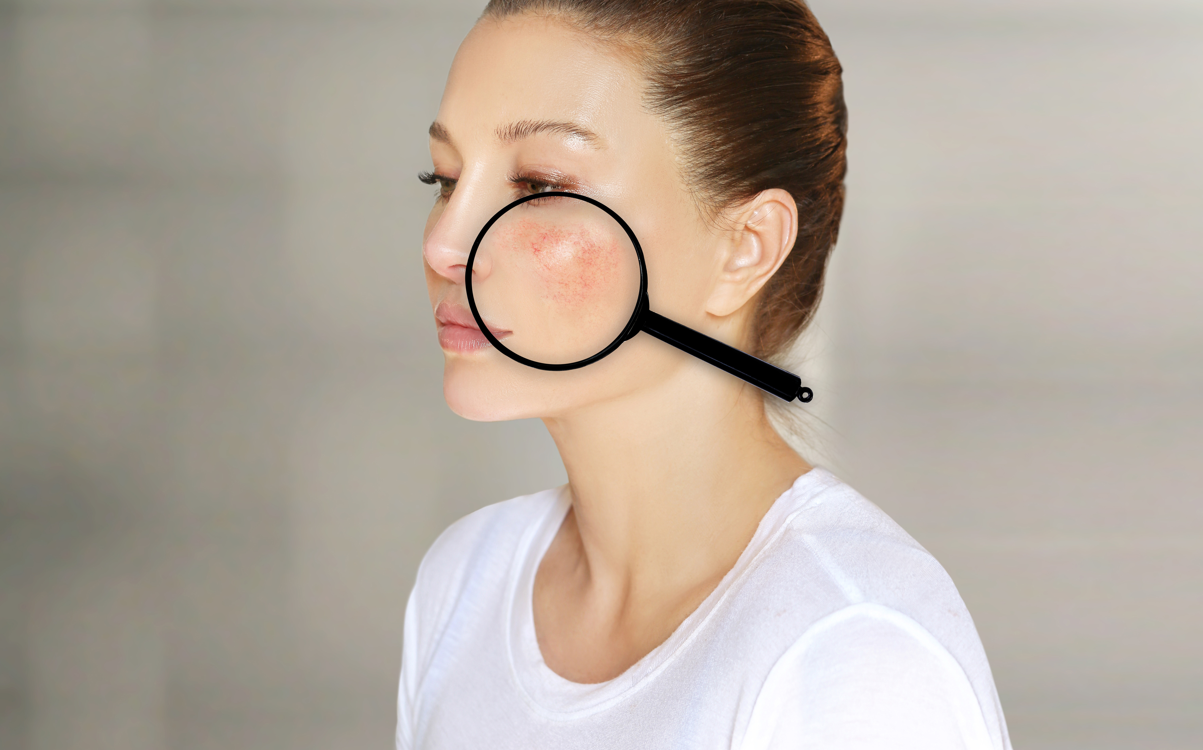 Rosacée ou couperose : causes, traitements de ces rougeurs sur le ...