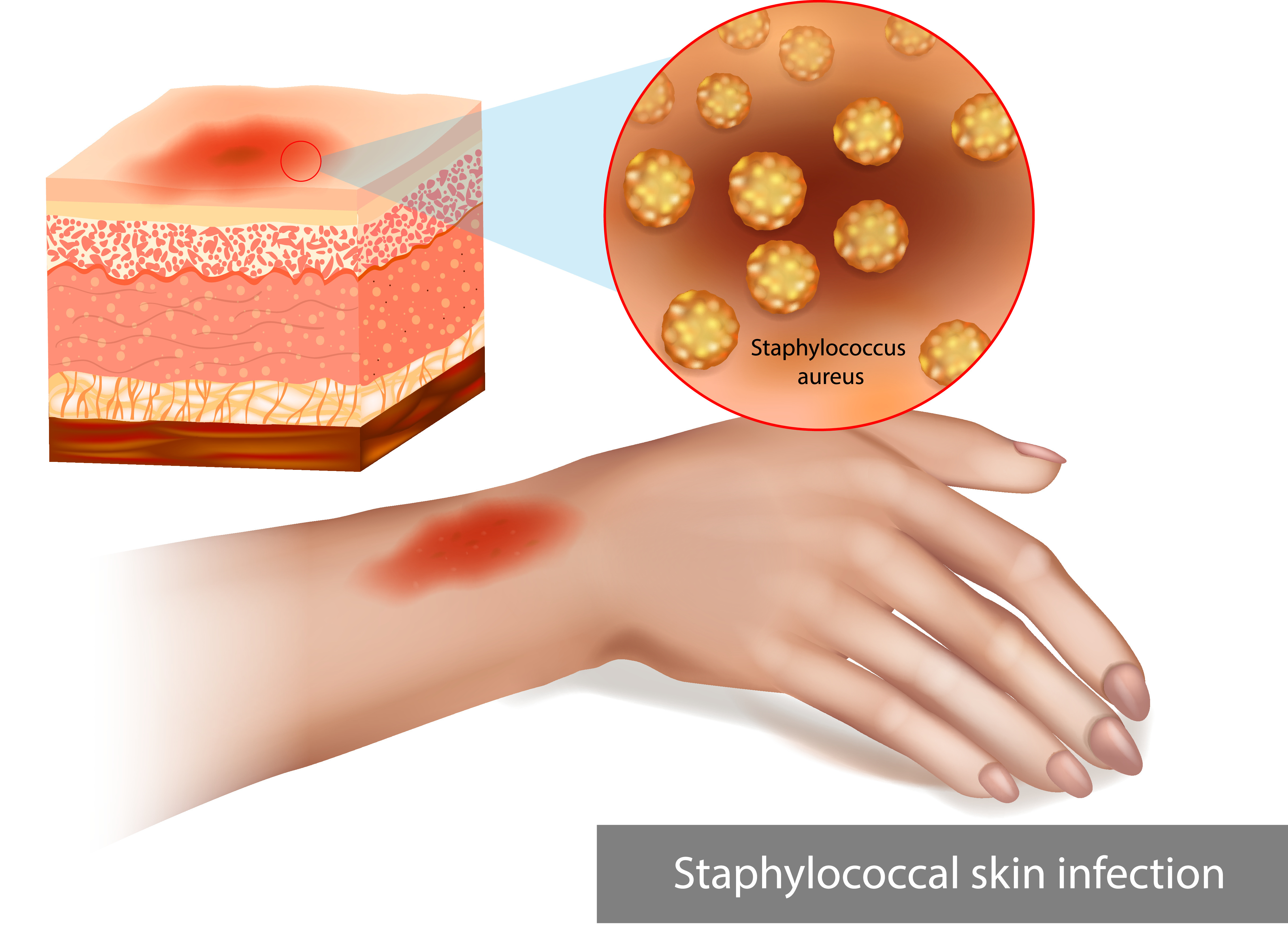 Cellulite infectieuse : causes, symptômes et traitements | Santé Magazine