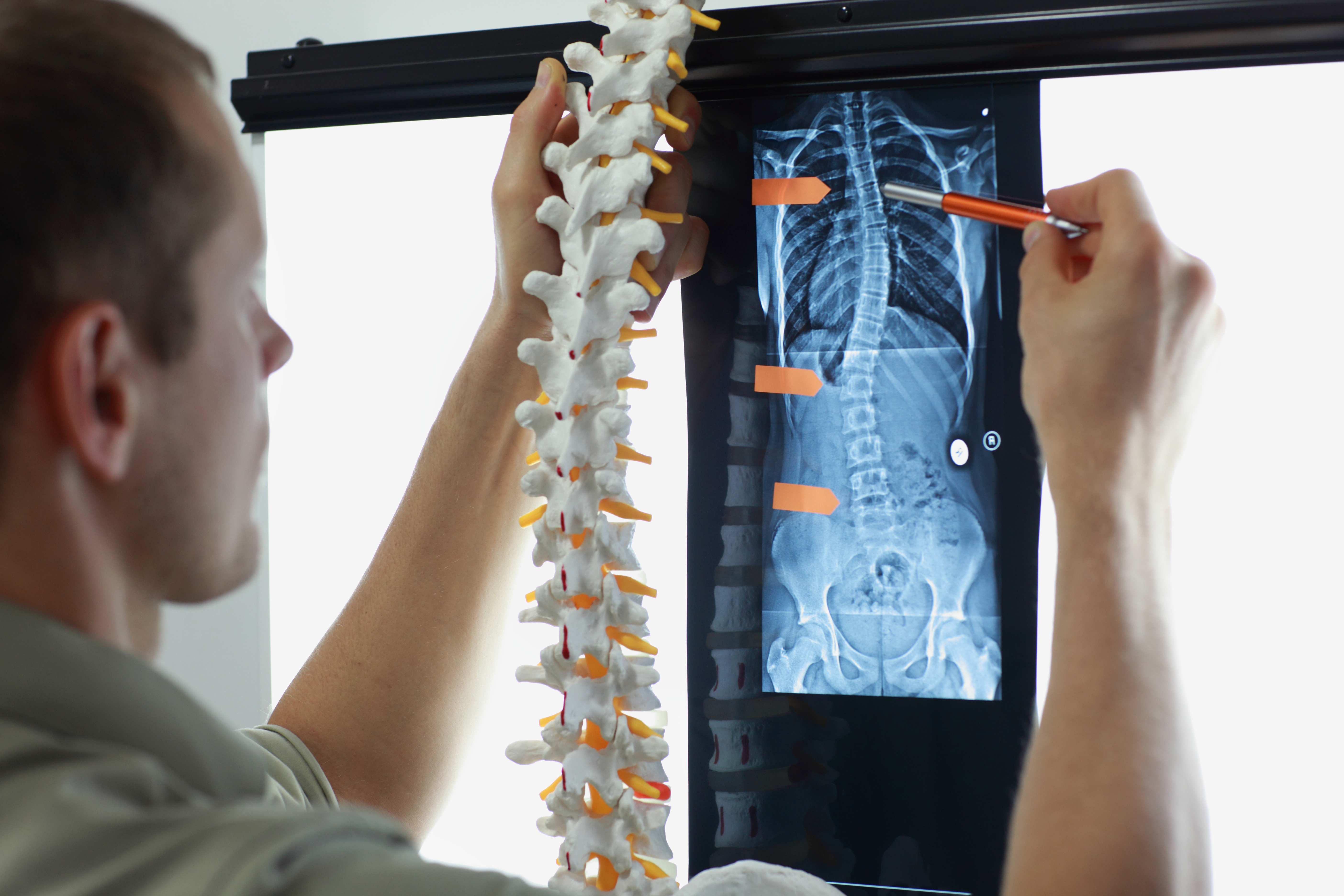 Scoliose : causes, traitements de cette déformation du dos | Santé Magazine