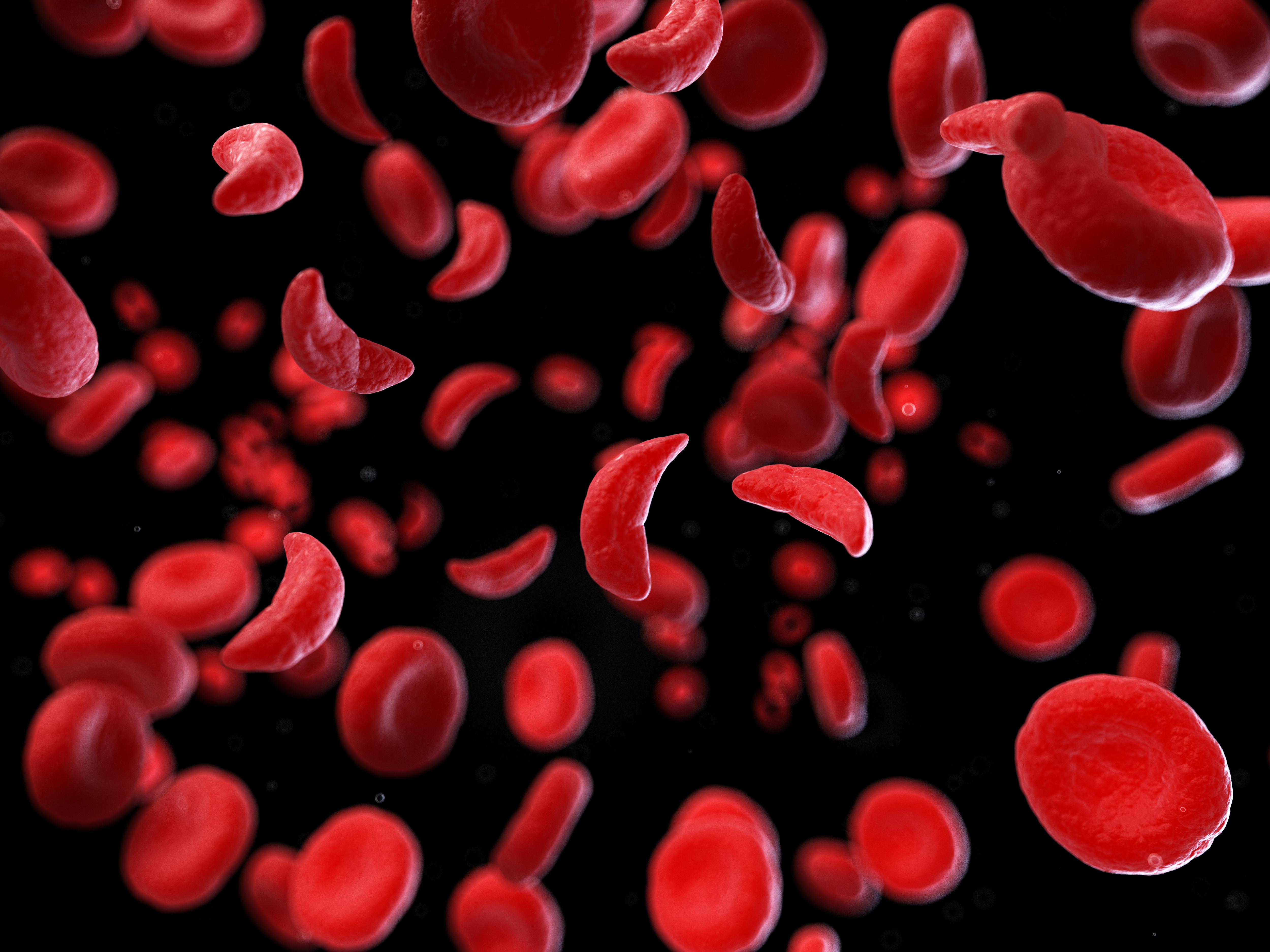 Drépanocytose : symptômes, causes, prévention, traitements | Santé Magazine