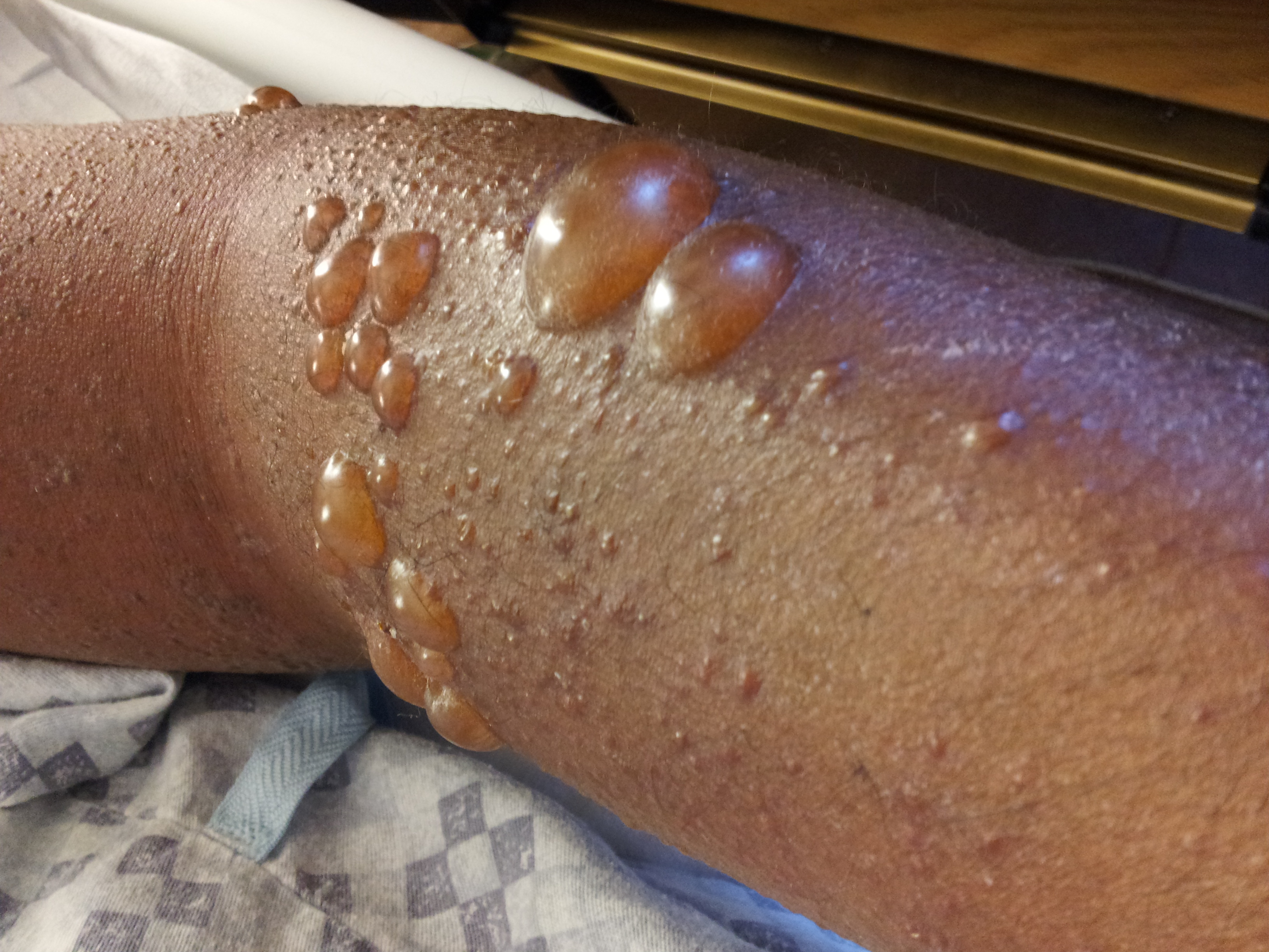 Pemphigoïde bulleuse : causes, symptômes et traitements | Santé Magazine