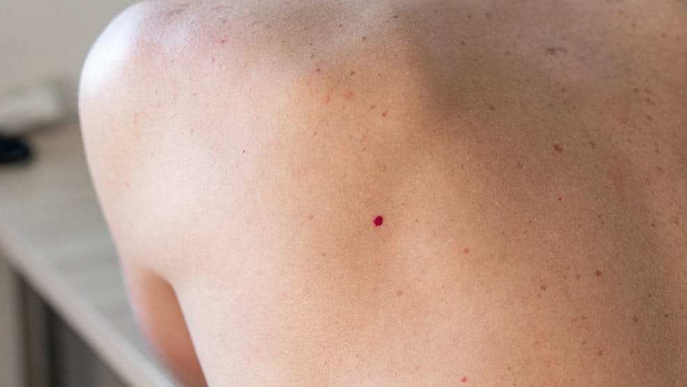 Grain De Beauté Rouge Faut Il Sinquiéter Santé Magazine
