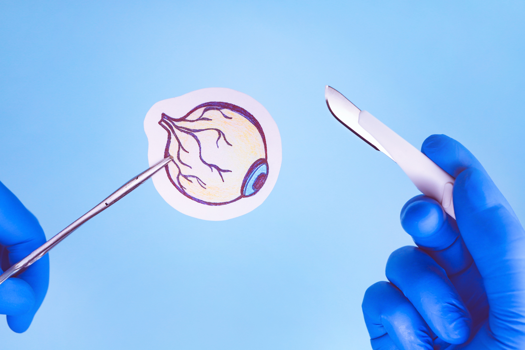 Première greffe oculaire au monde : que devient le patient un an plus ...