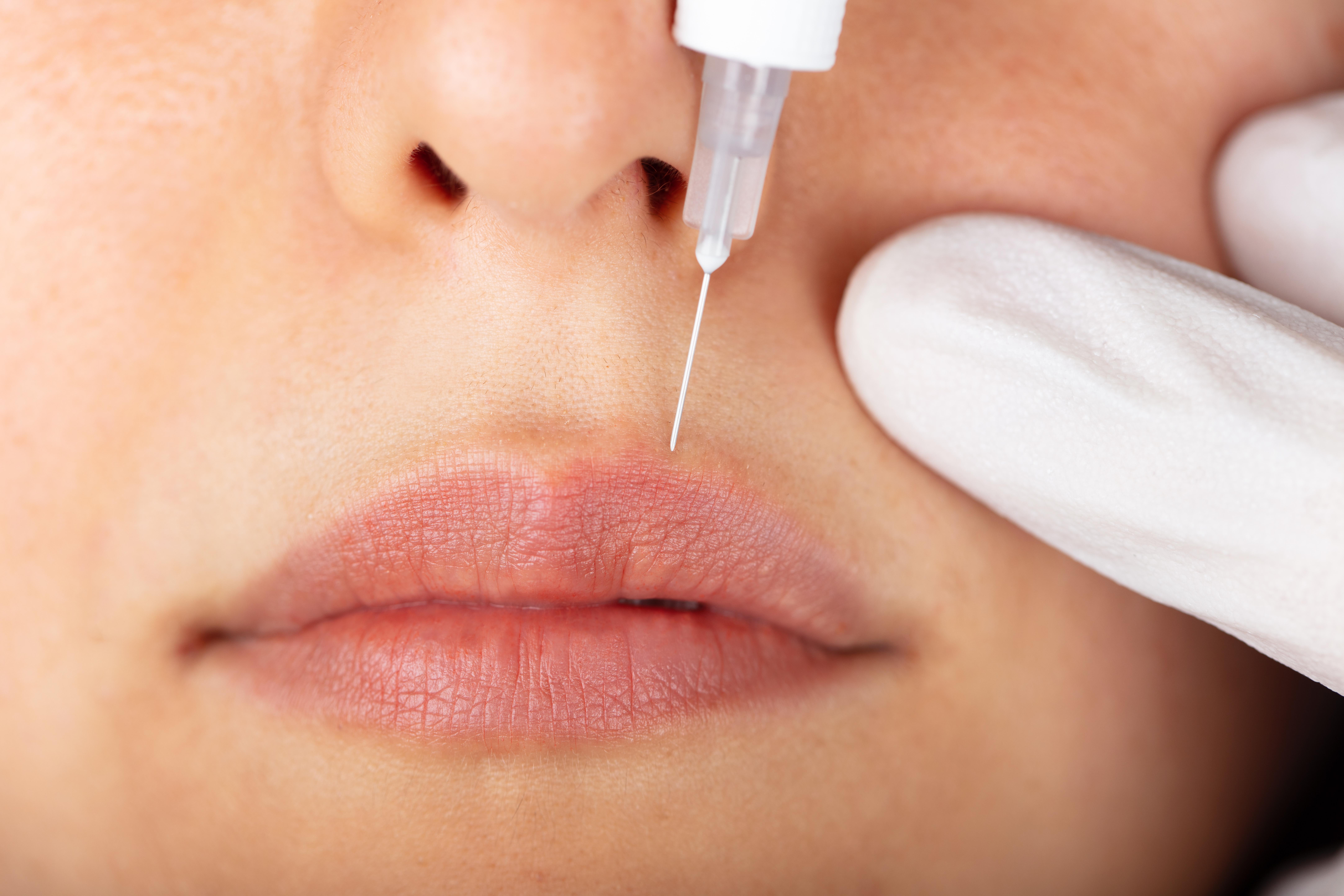 Gonflement après acide hyaluronique : est-ce normal et que faire ...