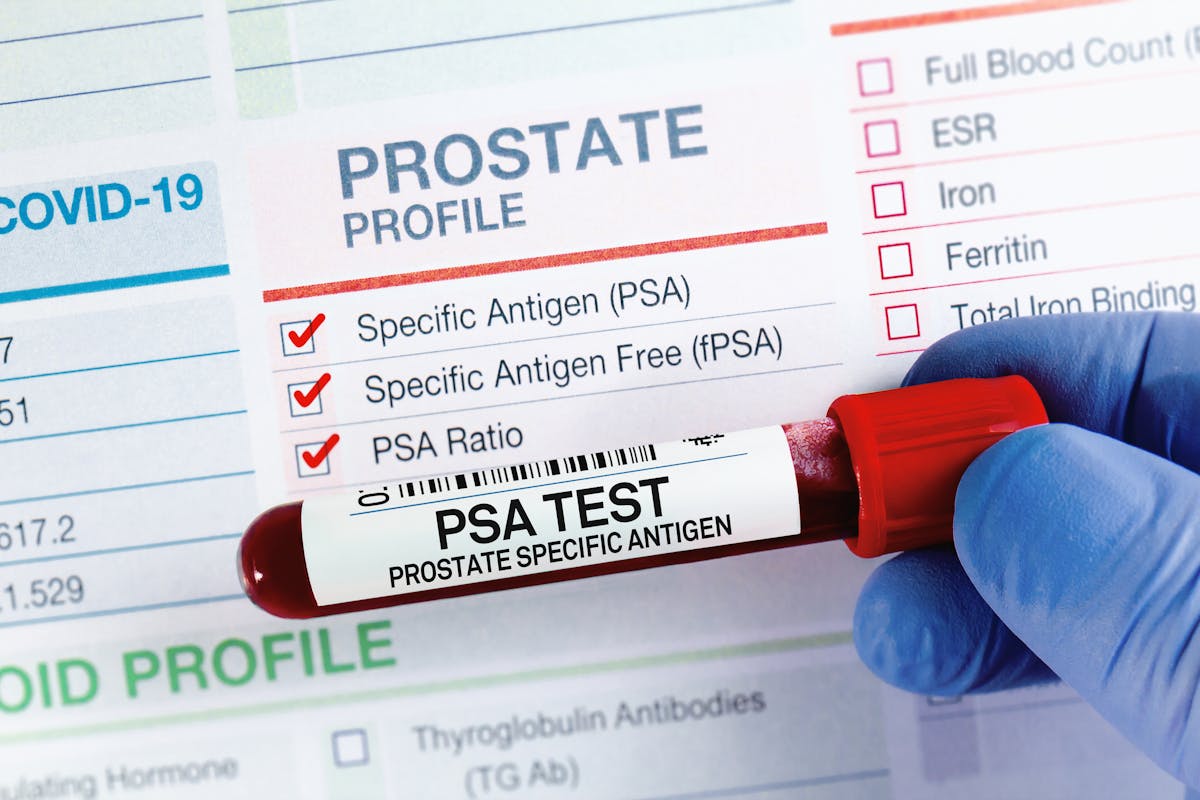 Prostate et taux de PSA : à quel âge ce dépistage ? pourquoi ? | Santé Magazine