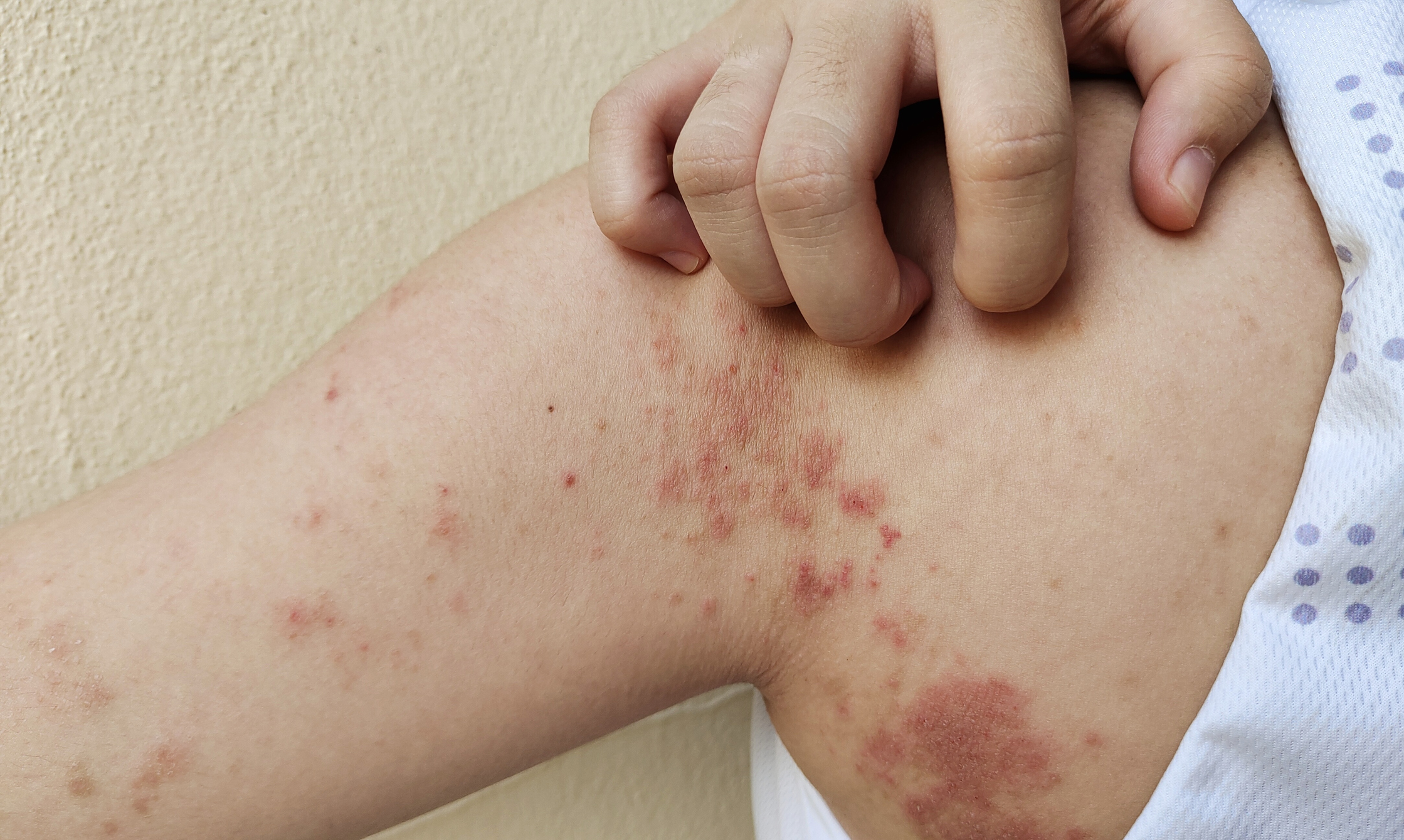 Urticaire, crise d’urticaire : causes, symptômes, traitements | Santé ...