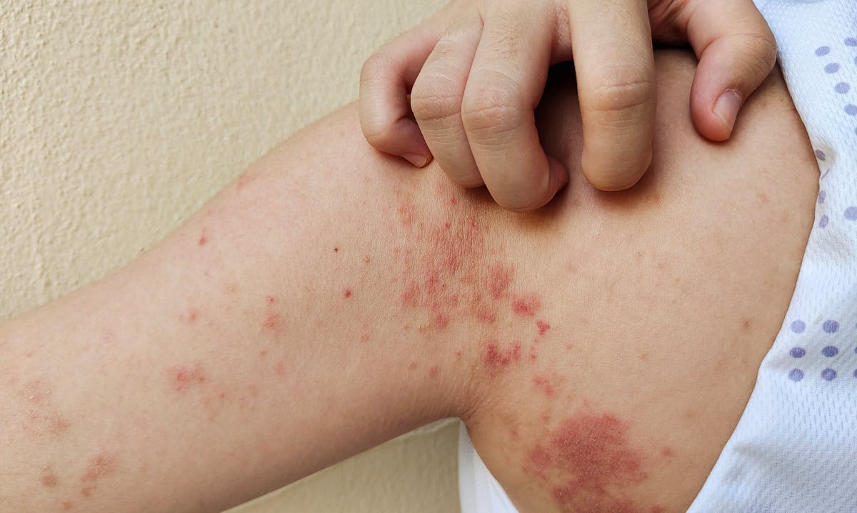 Urticaire, crise d’urticaire : causes, symptômes, traitements | Santé ...