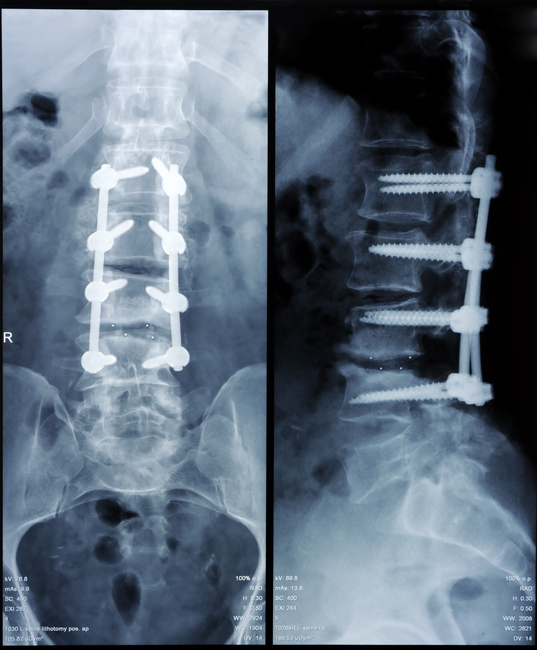 Discopathie : comprendre l'usure des disques du dos | Santé Magazine