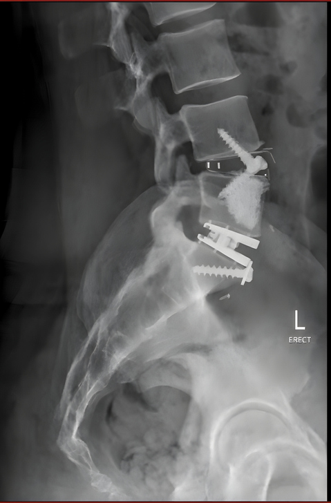 Discopathie : comprendre l'usure des disques du dos | Santé Magazine